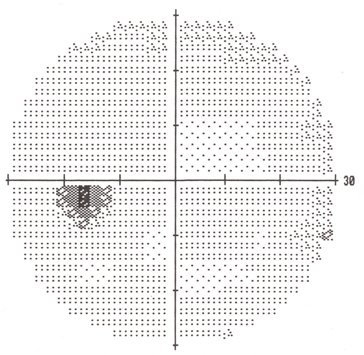 visual-field-normal-new-jersey-vision-associates